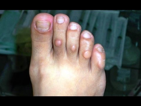 Como Eliminar Callos De Los Dedos De La Mano - Bambinos web